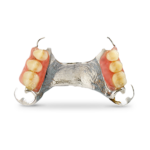 Cast Partials - Great State Dental Lab